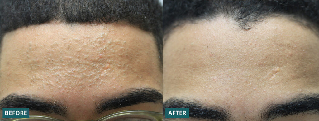 Acne | Dermatology & Laser Surgery Center