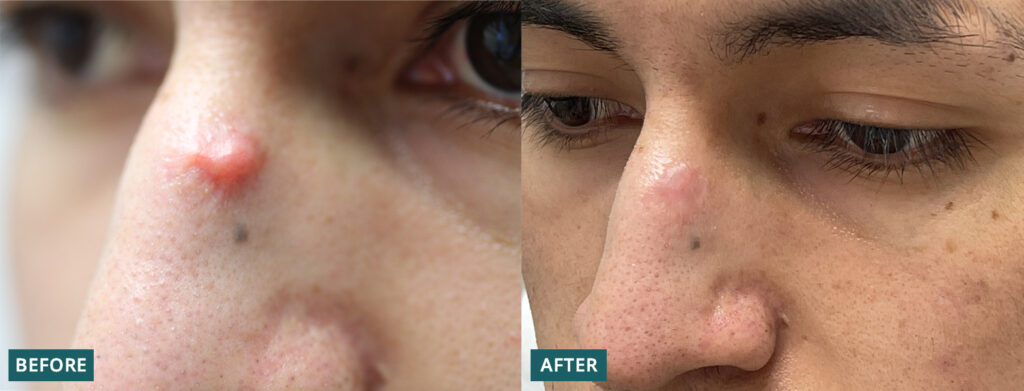 Keloid & Hypertrophic Scars