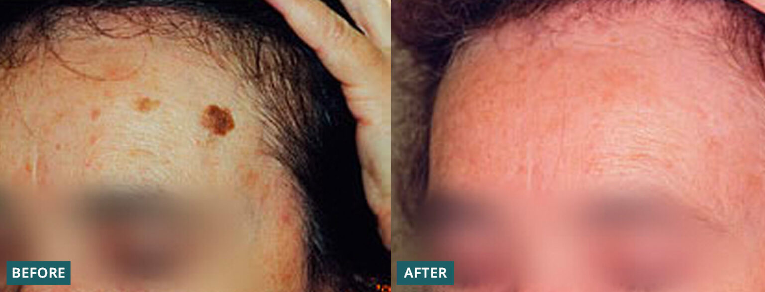 Sun Damage Lesions