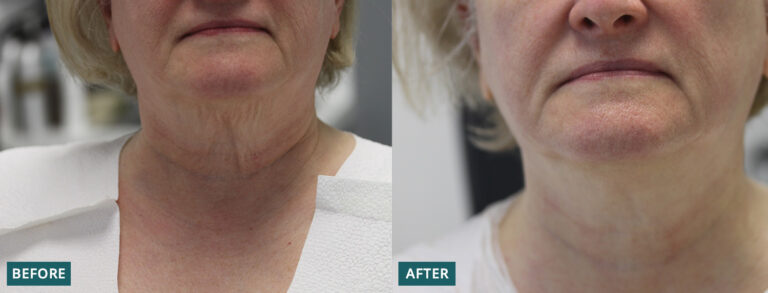 Microcurrent and Ultrasonic Skin Tightening